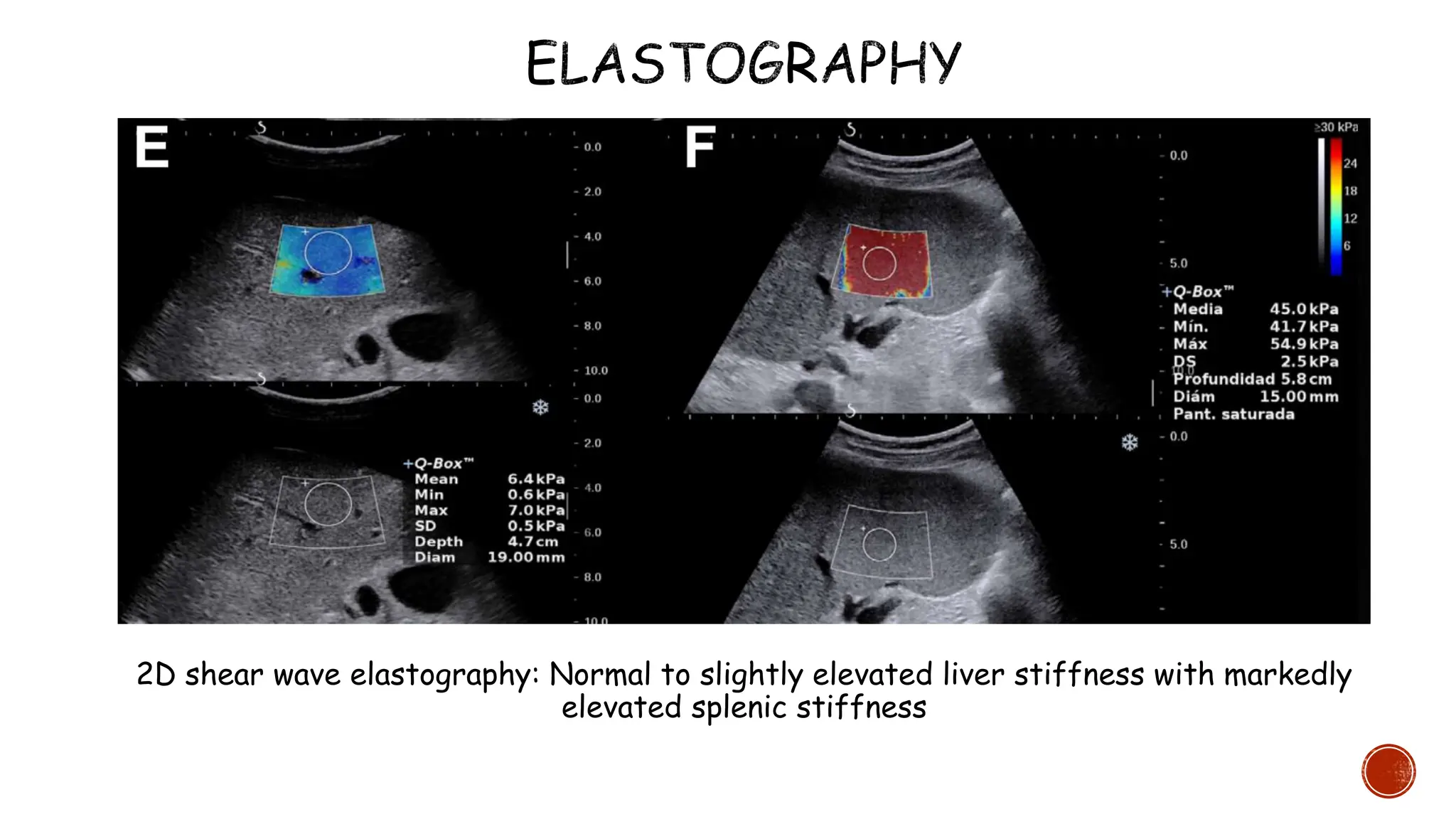 Portosinusoidal Vascular Disease (PSVD) | PPTX