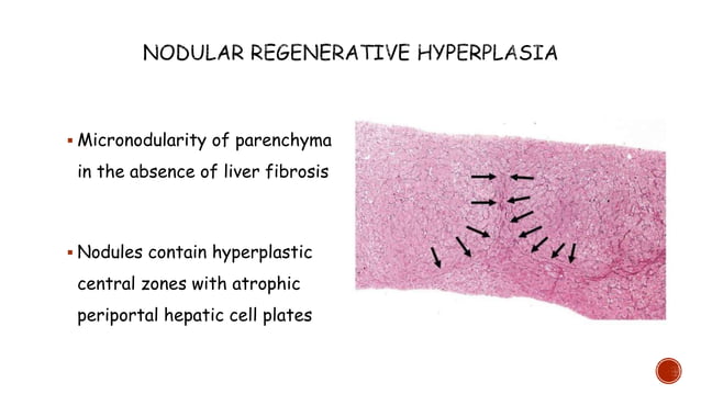 Portosinusoidal Vascular Disease (PSVD) | PPTX | Blood Disorders ...