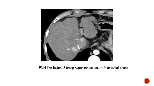 Portosinusoidal Vascular Disease (PSVD) | PPTX | Blood Disorders ...
