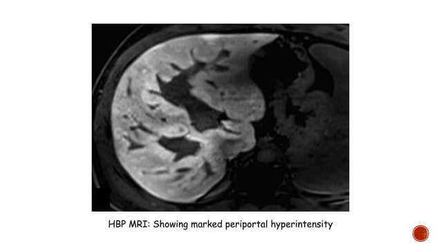 Portosinusoidal Vascular Disease (PSVD) | PPTX | Blood Disorders ...