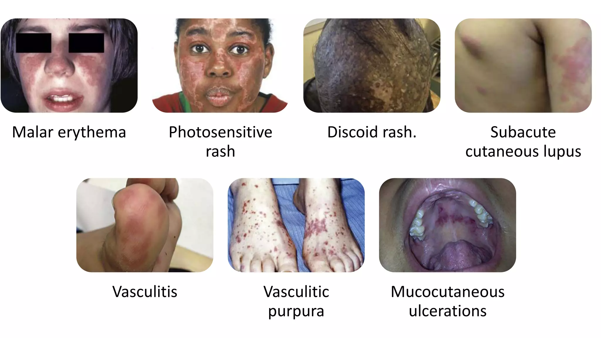Psychiatric comorbidity in child onset lupus | PPTX