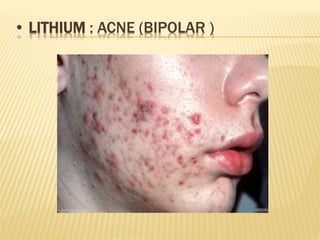 Psychological aspects of skin disease | PPTX