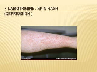 Psychological aspects of skin disease | PPTX