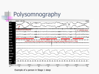 Poor sleep as a risk factor for postnatal depression | PPT