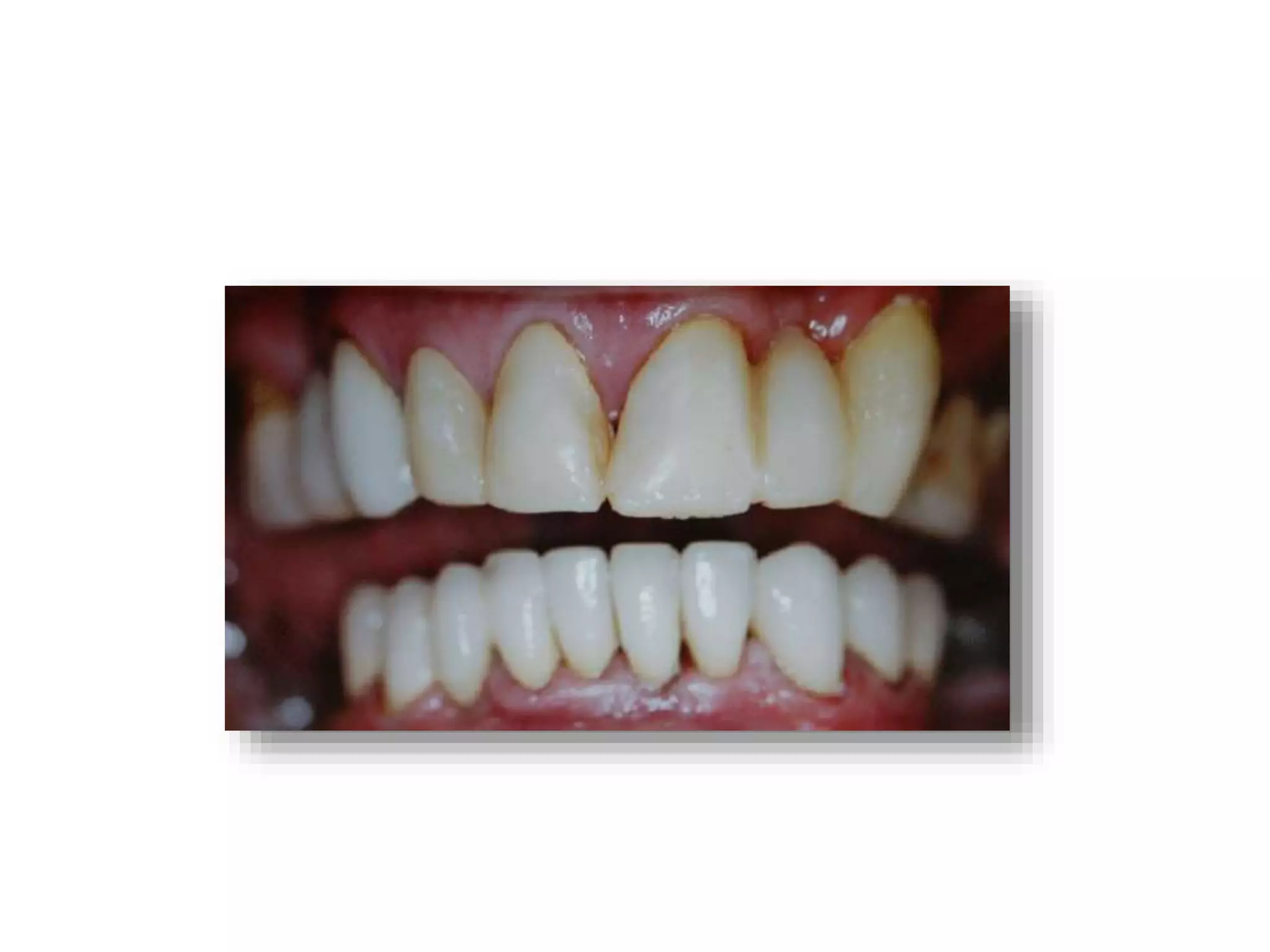 Telescopic milled PFM\'s to seat claspless RPD\'s. | PPTX