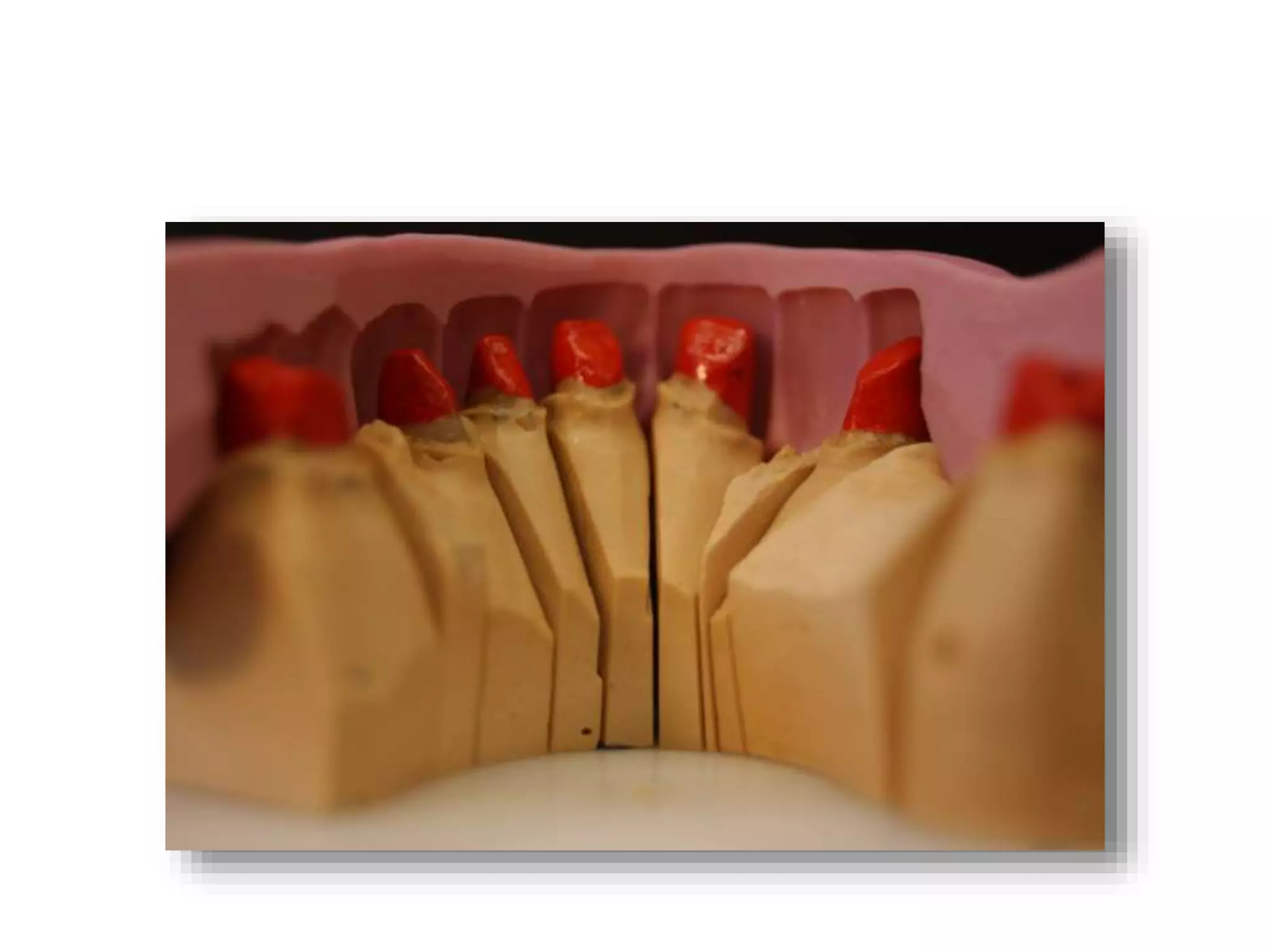 Telescopic milled PFM\'s to seat claspless RPD\'s. | PPT