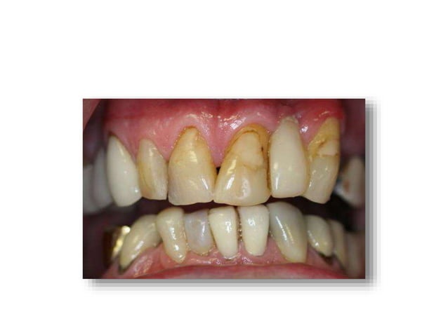 Telescopic milled PFM\'s to seat claspless RPD\'s. | PPTX