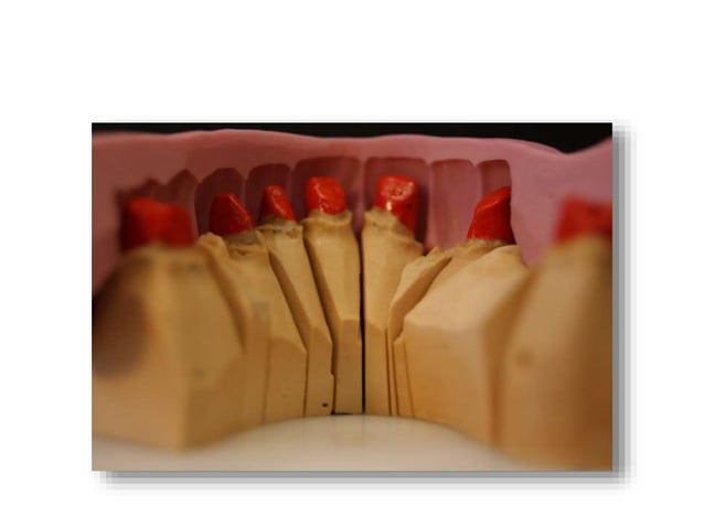 Telescopic milled PFM\'s to seat claspless RPD\'s. | PPT