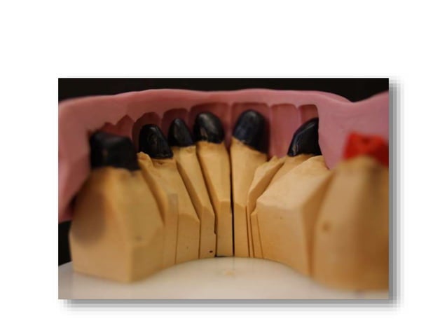 Telescopic milled PFM\'s to seat claspless RPD\'s. | PPTX