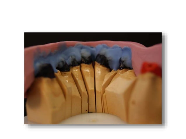 Telescopic milled PFM\'s to seat claspless RPD\'s. | PPTX