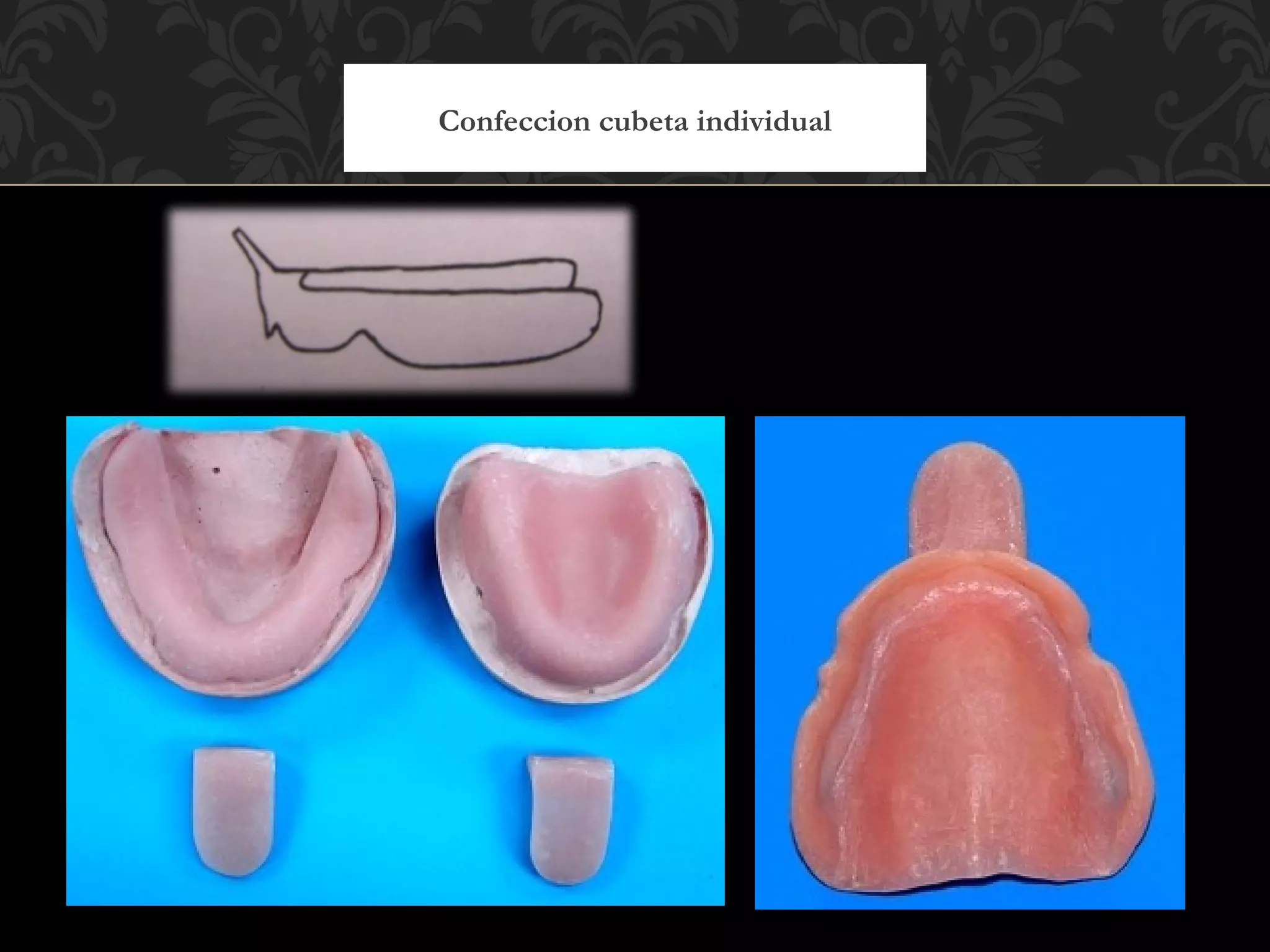 Impresion Definitiva en Protesis Total | PPT