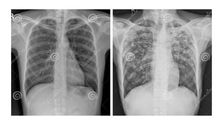 Lay Forum on Pulmonary Tuberculosis.pptx