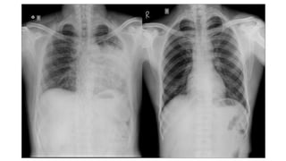 Lay Forum on Pulmonary Tuberculosis.pptx