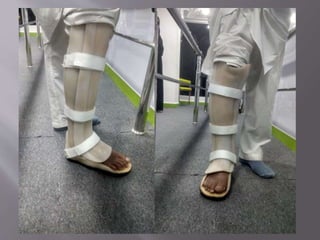 PTB #brace.pptx
