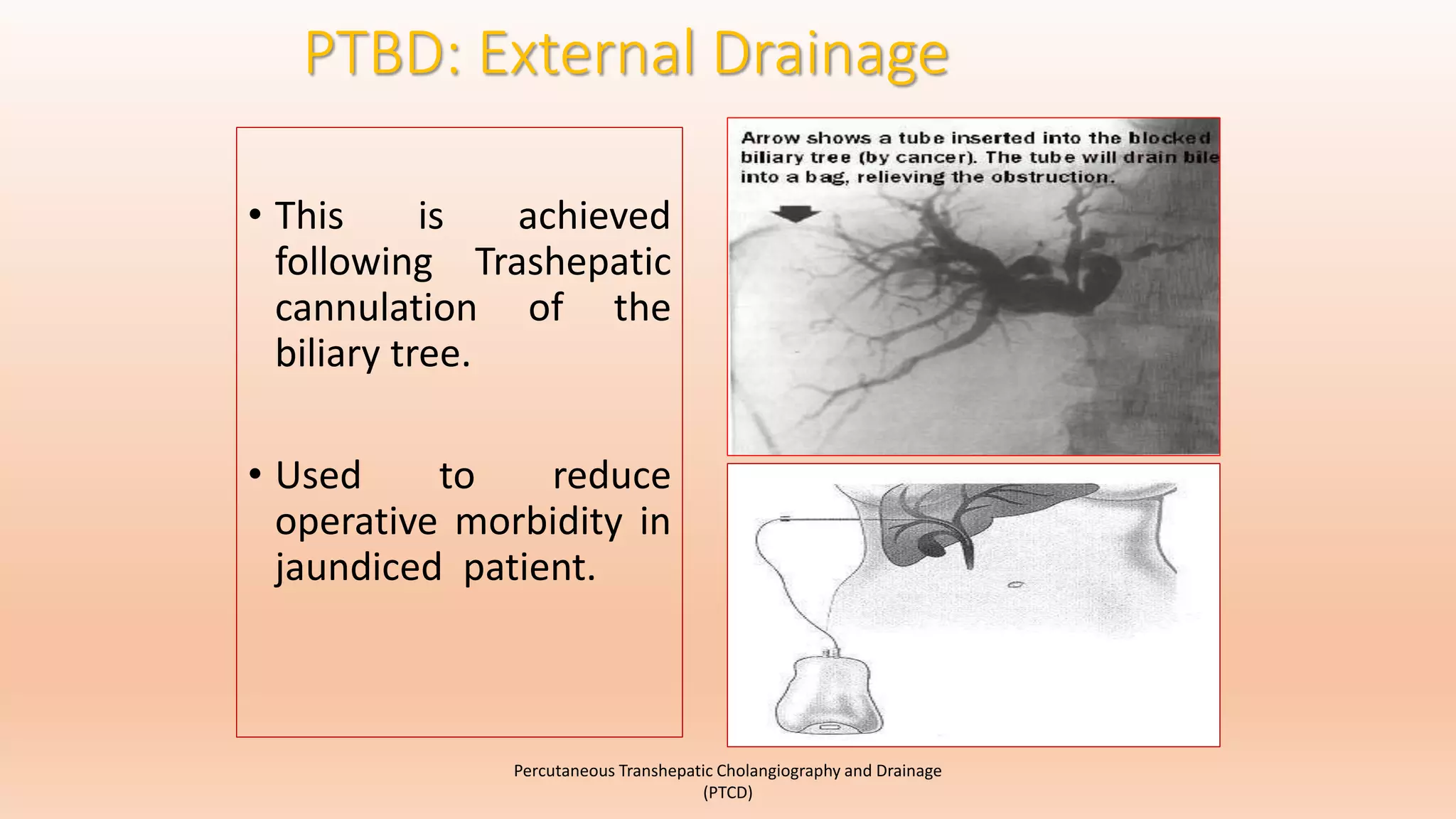 PTBD (Percutaneus trans-hepatic biliary drainage) PPT,PDF PK | PPTX