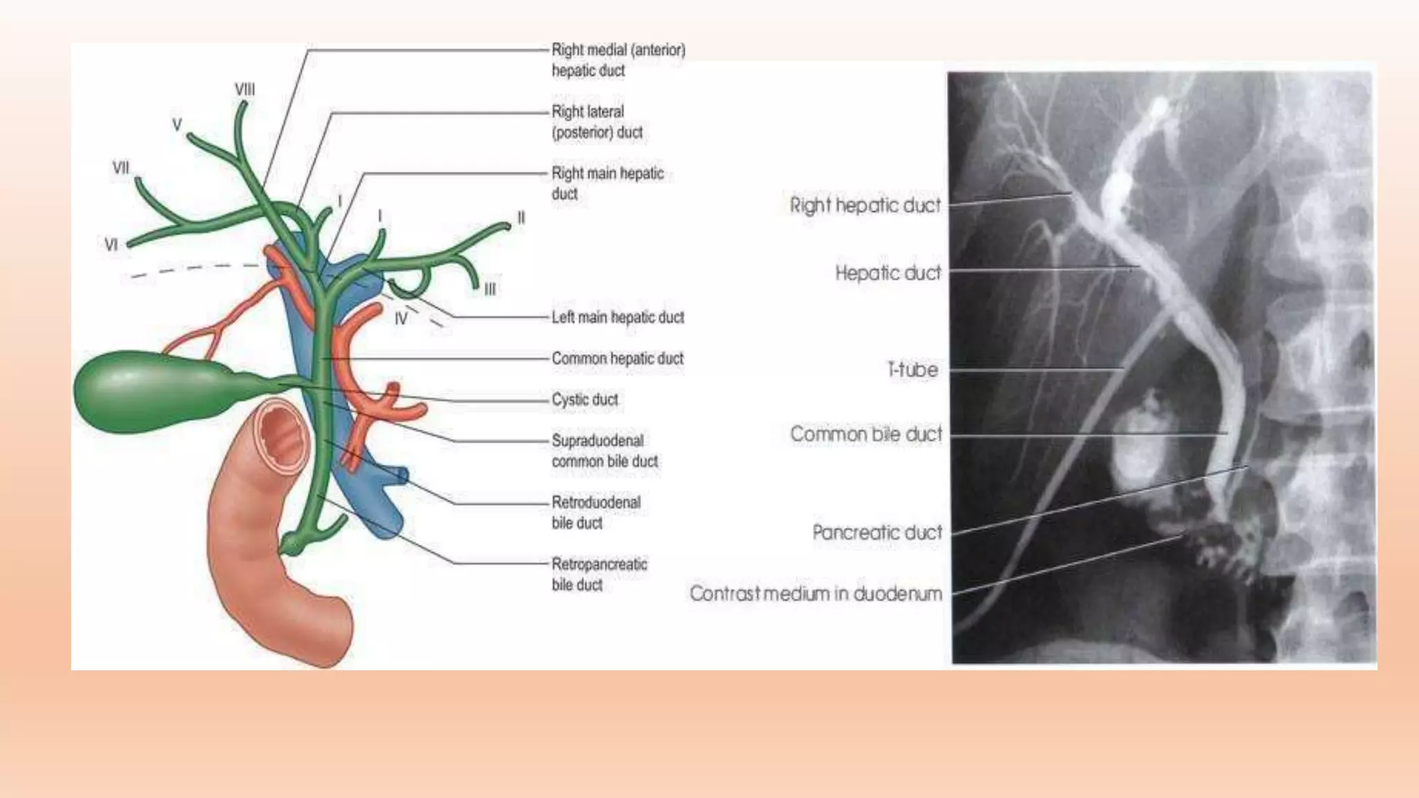 PTBD (Percutaneus trans-hepatic biliary drainage) PPT,PDF PK | PPTX