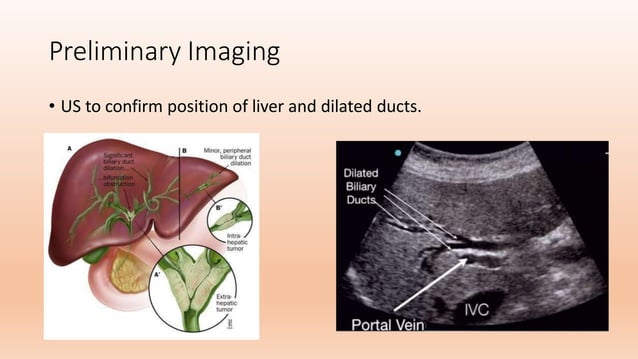 PTBD (Percutaneus trans-hepatic biliary drainage) PPT,PDF PK | PPTX