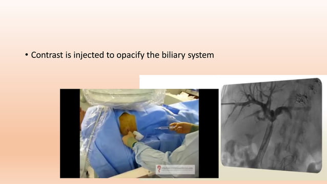 PTBD (Percutaneus trans-hepatic biliary drainage) PPT,PDF PK | PPTX