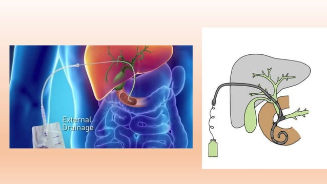 PTBD (Percutaneus trans-hepatic biliary drainage) PPT,PDF PK | PPTX
