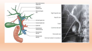 PTBD (Percutaneus trans-hepatic biliary drainage) PPT,PDF PK | PPTX