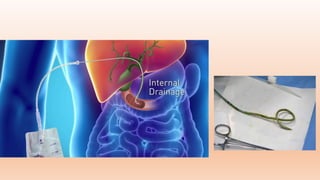 PTBD (Percutaneus trans-hepatic biliary drainage) PPT,PDF PK | PPTX