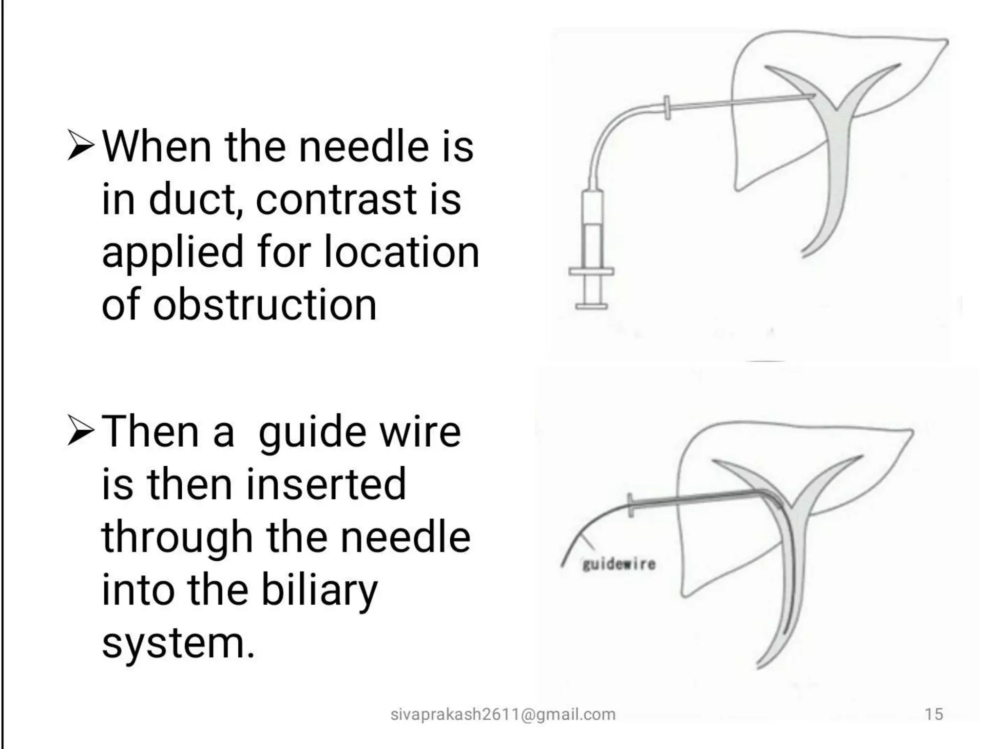 PTBD Percutaneous transhepatic biliary drainage | PPTX