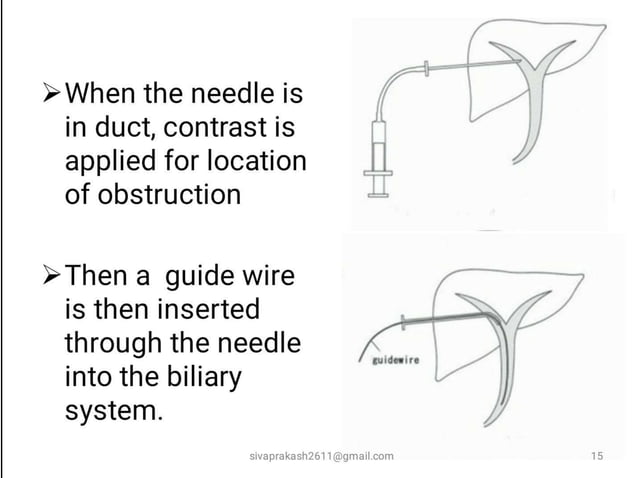 PTBD Percutaneous transhepatic biliary drainage | PPTX | Surgery ...
