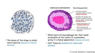 Pulmonary Tuberculosis, Integrated teaching Dr Naila.pptx