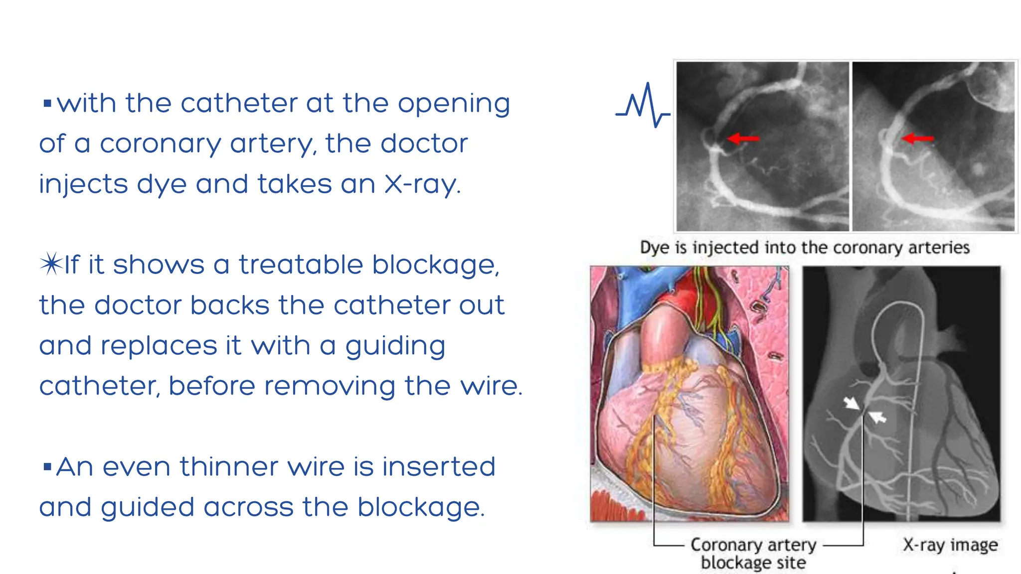 Percutaneous transluminal coronary angioplasty (PTCA) and coronary ...