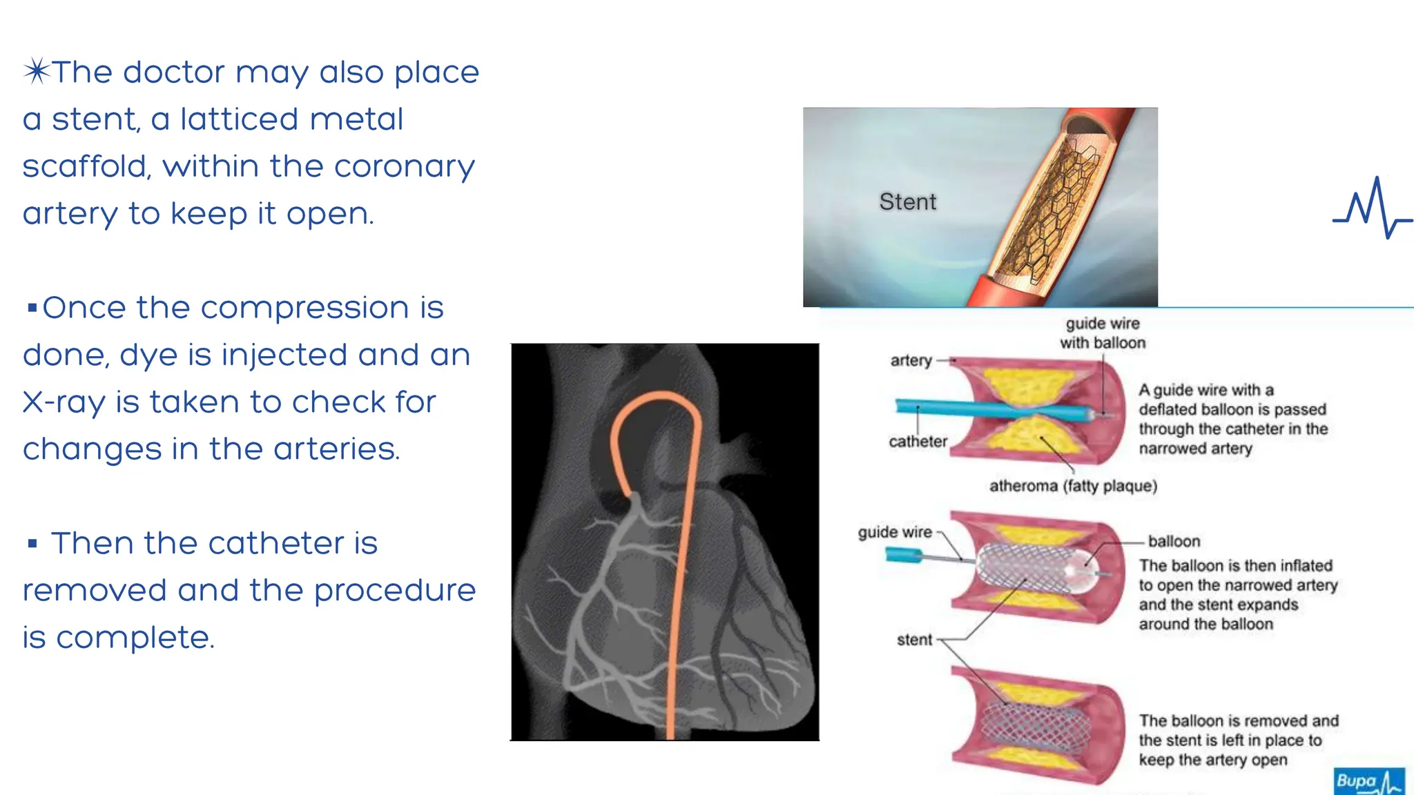 Percutaneous transluminal coronary angioplasty (PTCA) and coronary artery bypass graft (CABG) | PPTX