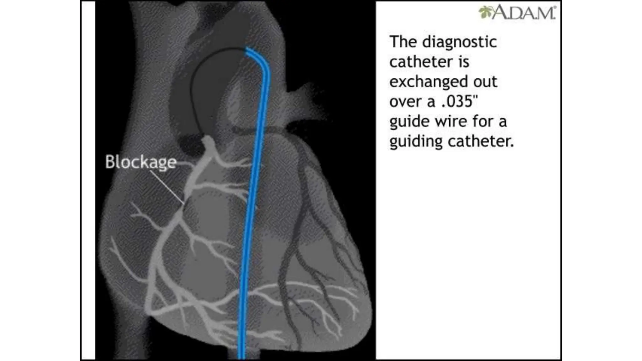 Percutaneous transluminal coronary angioplasty (PTCA) and coronary artery bypass graft (CABG) | PPTX