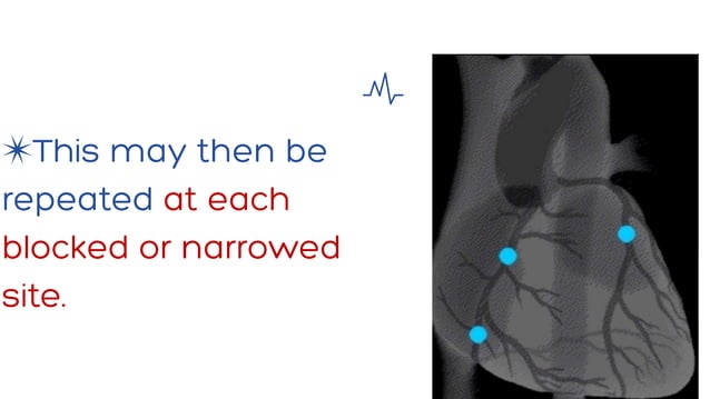 Percutaneous transluminal coronary angioplasty (PTCA) and coronary ...