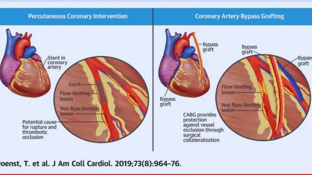 Percutaneous transluminal coronary angioplasty (PTCA) and coronary artery bypass graft (CABG) | PPTX