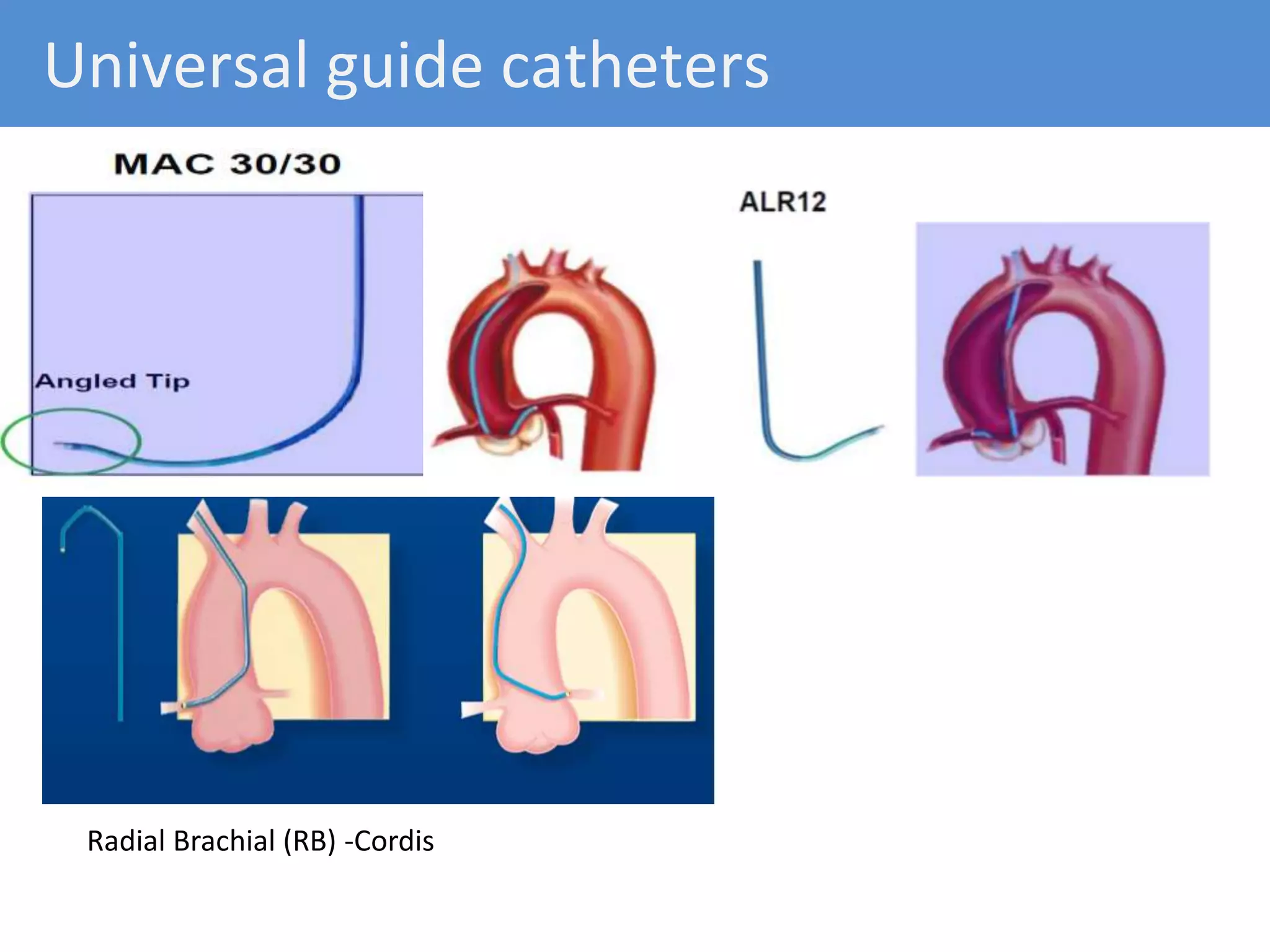 Catheters used in Angiography & angioplasty | PPTX
