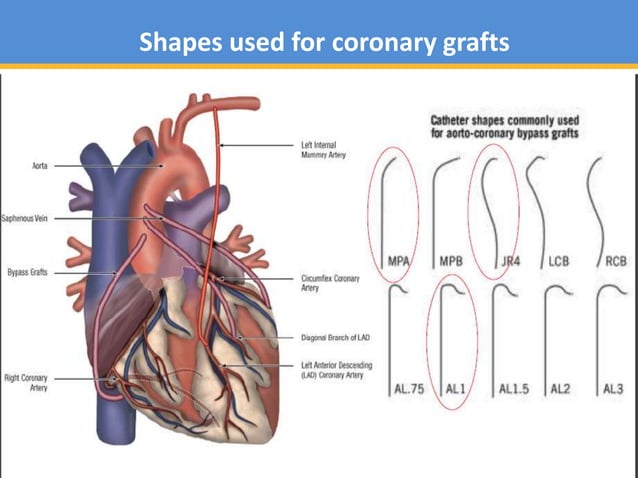 Catheters used in Angiography & angioplasty | PPTX | Heart and ...