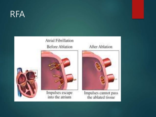 ptca rfa ppt.pptx, PTCA RFA, Percutaneous translu | PPTX