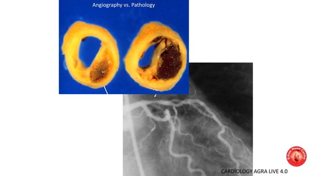 Angioplasty vs medical management in CAD(ANGINA) .pptx