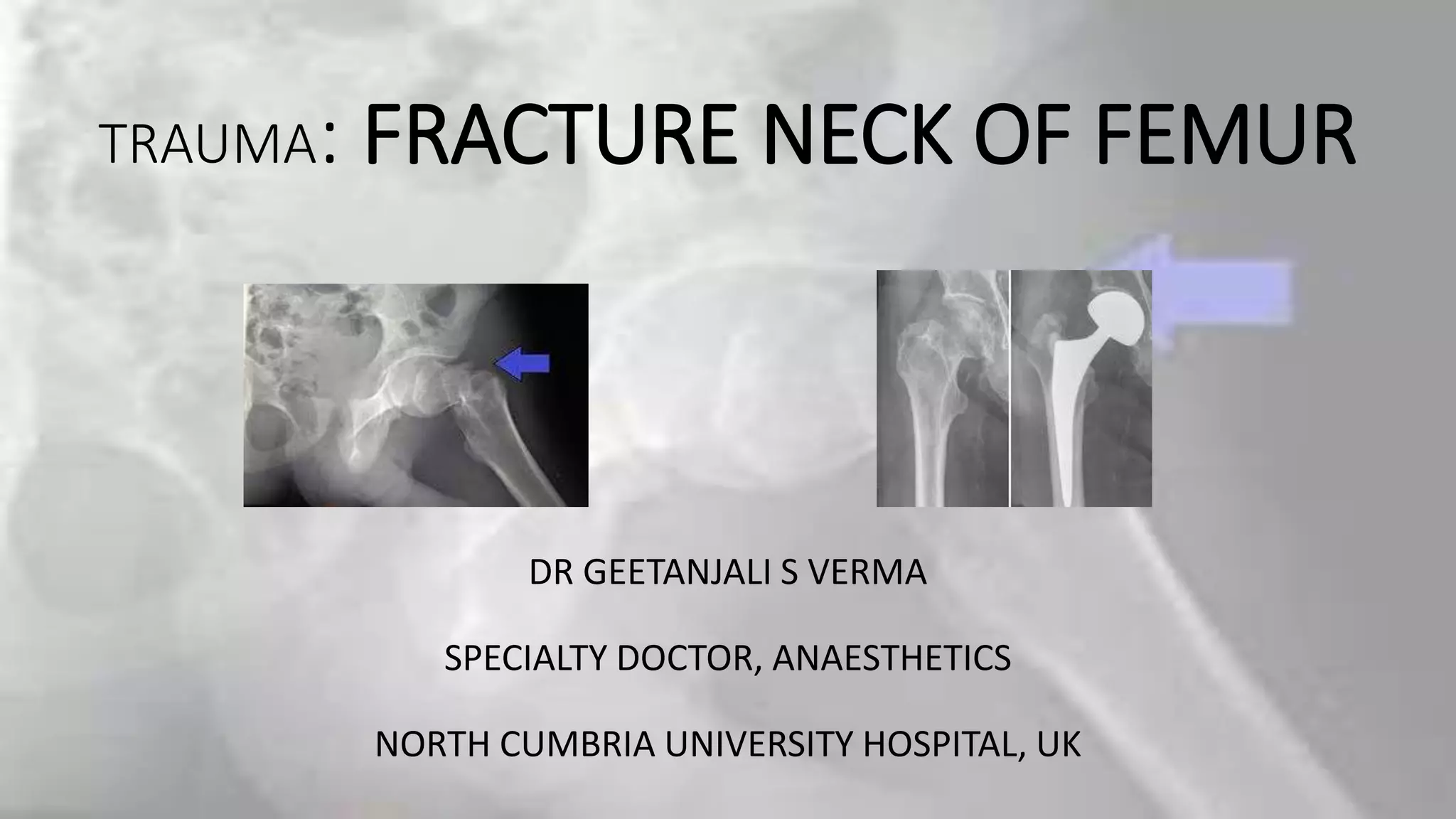 Fracture NOF: guidelines & audit | PPTX