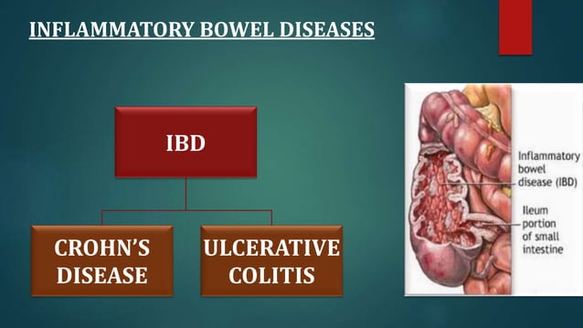 IBD | PPT