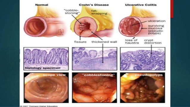 IBD