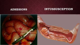 intestinal obstruction | PPTX