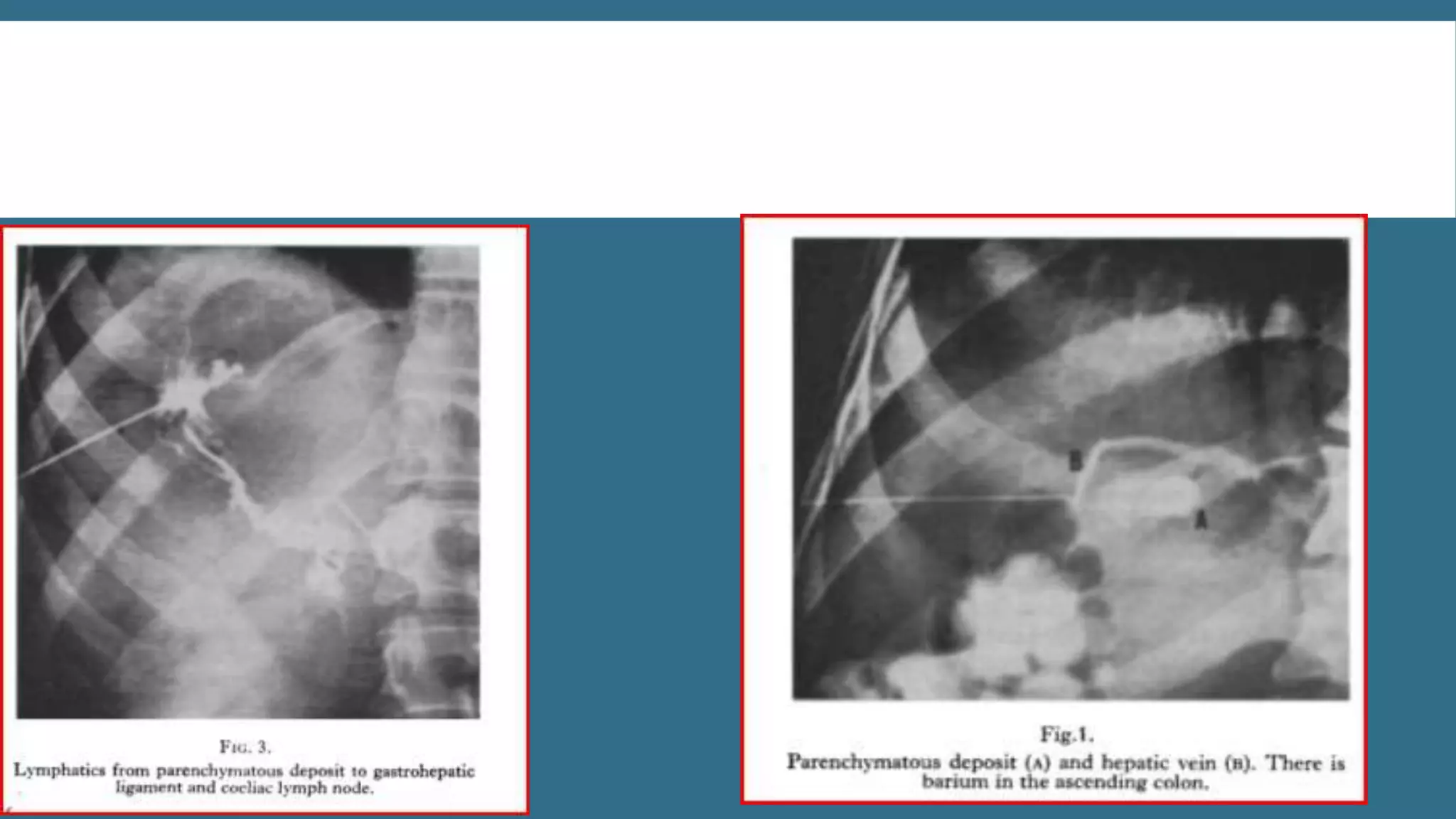 Ptc )percutaneous transhepatic cholangiography | PPTX