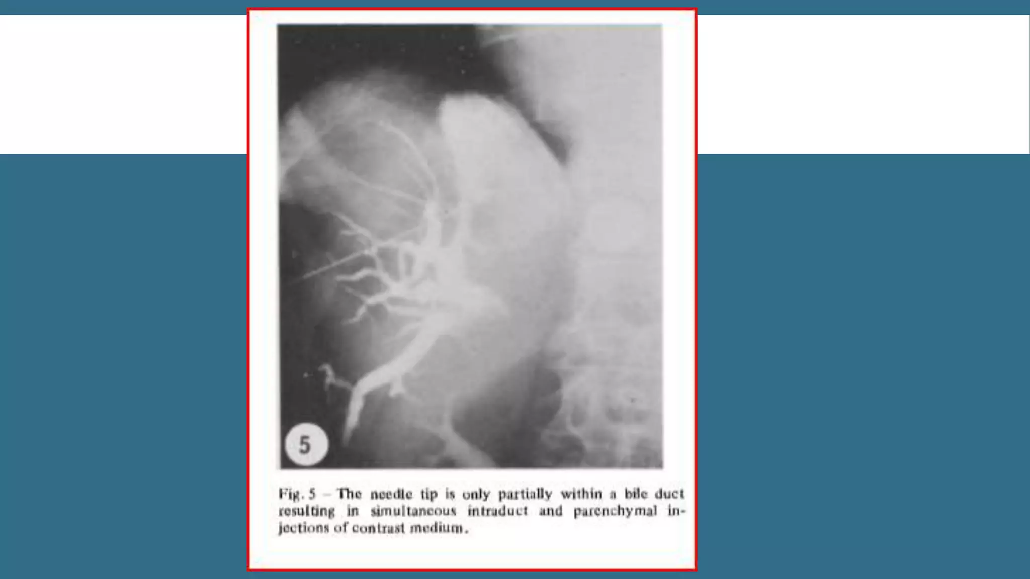 Ptc )percutaneous transhepatic cholangiography | PPTX