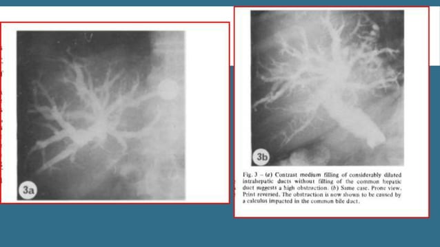 Ptc )percutaneous transhepatic cholangiography | PPTX | Digestive ...