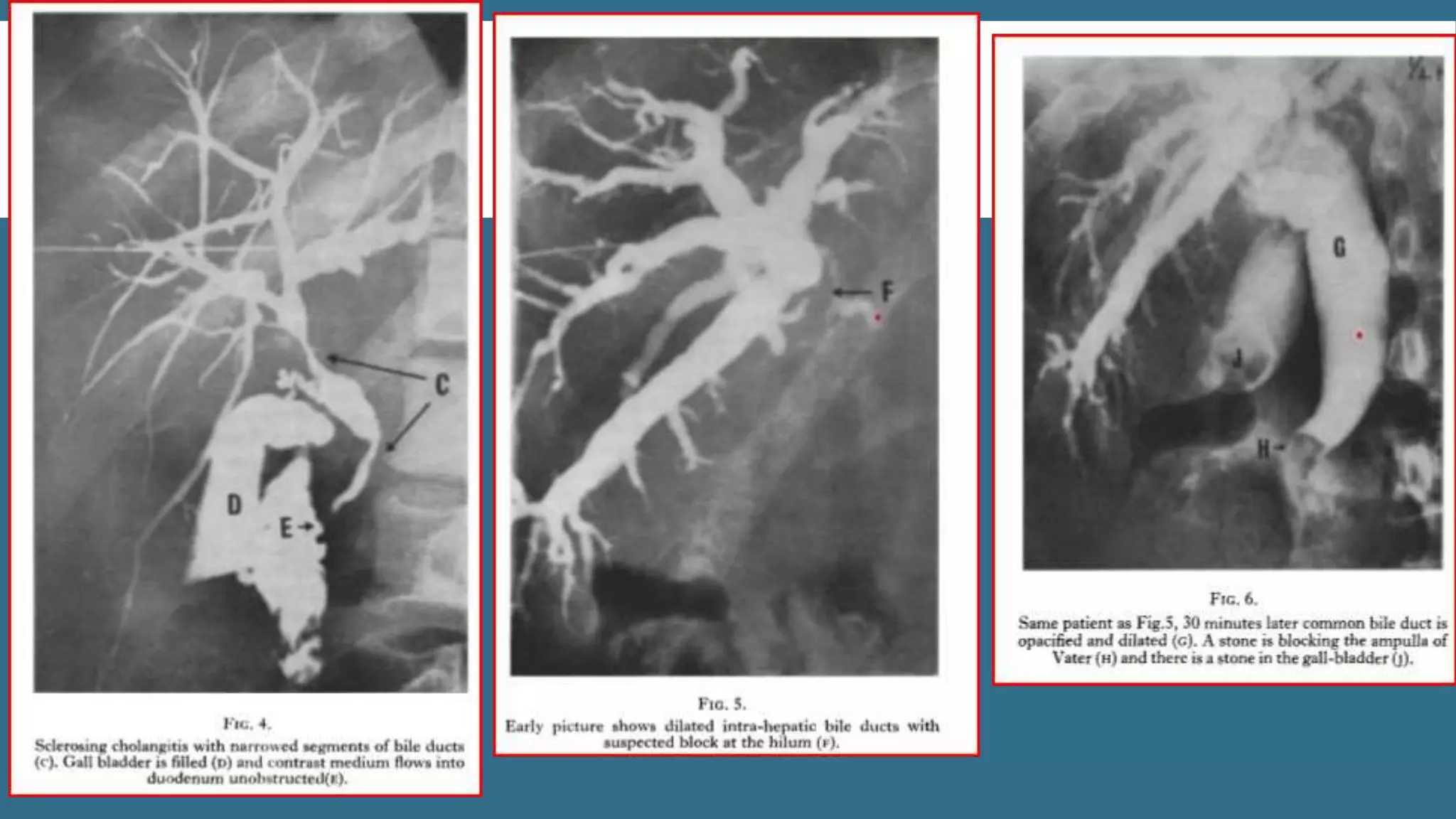 Ptc )percutaneous transhepatic cholangiography | PPTX