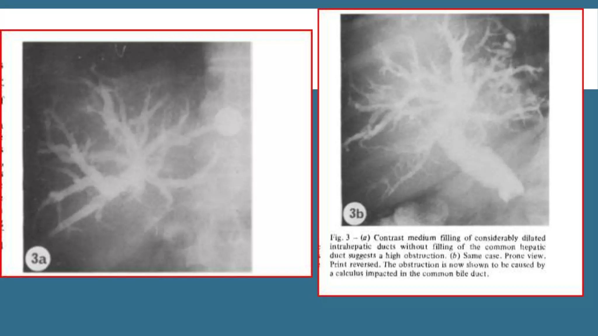 Ptc )percutaneous transhepatic cholangiography | PPTX
