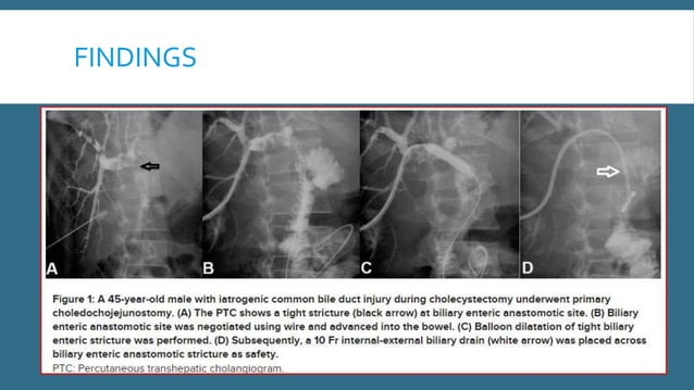 Ptc )percutaneous transhepatic cholangiography | PPTX