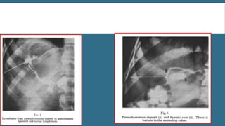 Ptc )percutaneous transhepatic cholangiography | PPTX