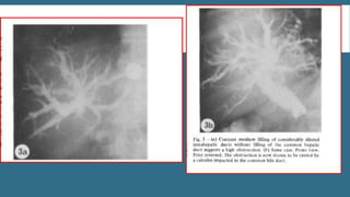Ptc )percutaneous transhepatic cholangiography | PPTX