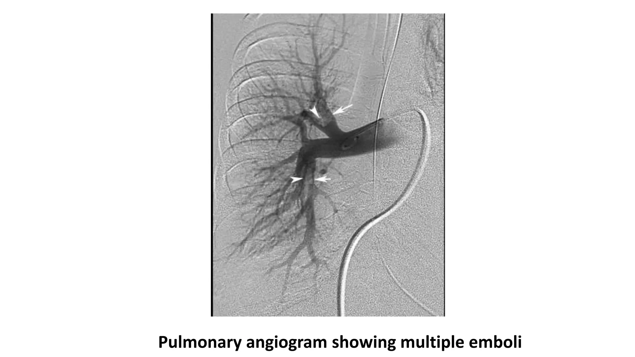Pulmonary thromboembolism | PPTX